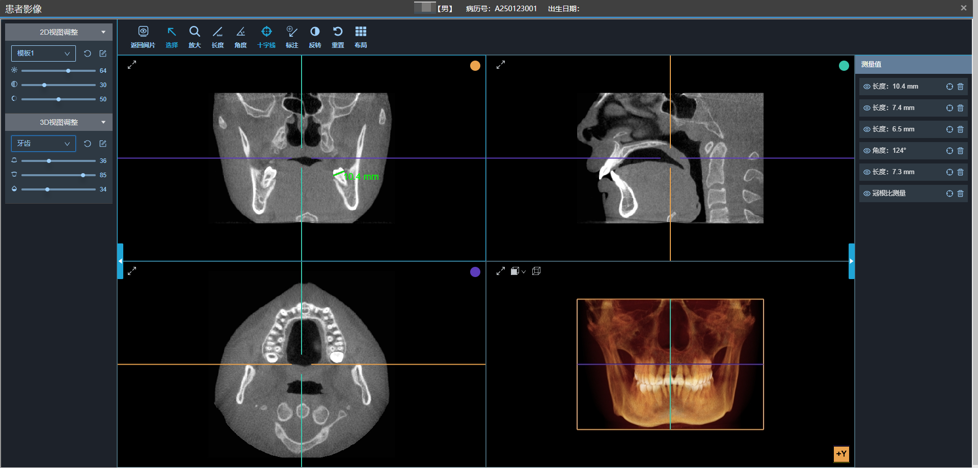 【影像】3D MPR 功能说明-e看牙口腔门诊管理系统